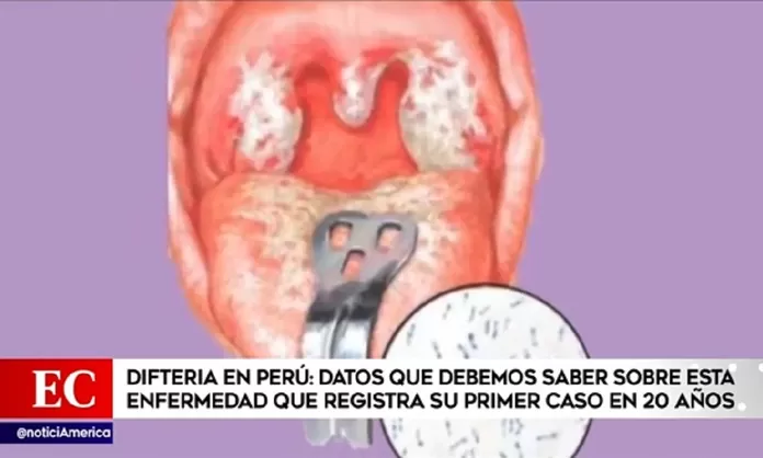 Difteria en Perú: ¿Qué es esta enfermedad y cómo se transmite?