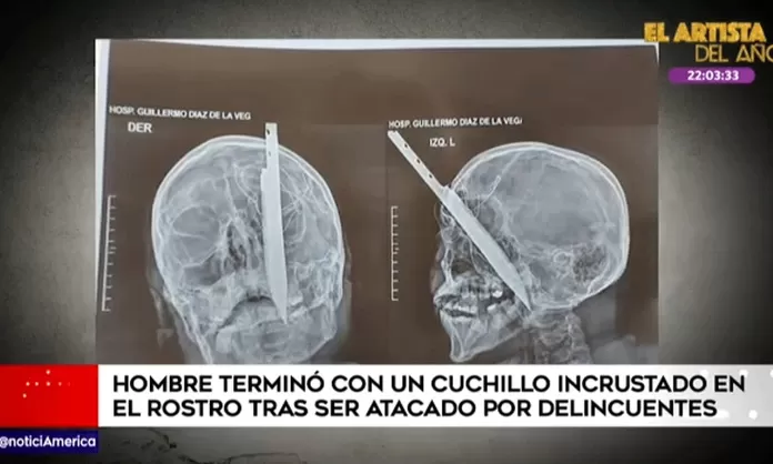 Hombre terminó con un cuchillo incrustado en el rostro tras ser atacado ...