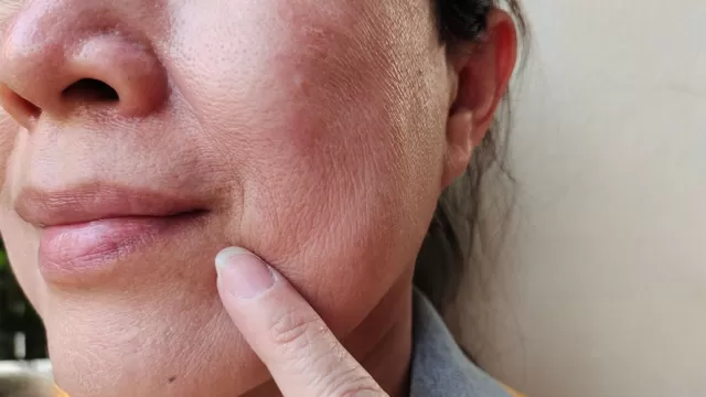 Cáncer de labios o boca síntomas - América Noticias