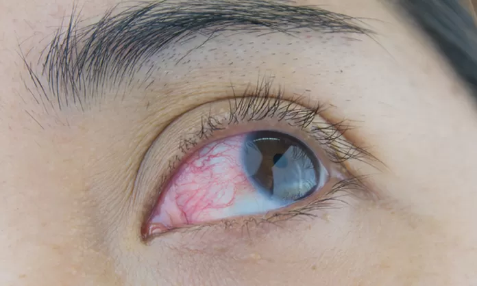 Carnosidad en los ojos: cómo empieza