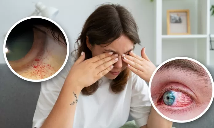 ¿Cómo aparecen las várices en los ojos y por qué se forman?