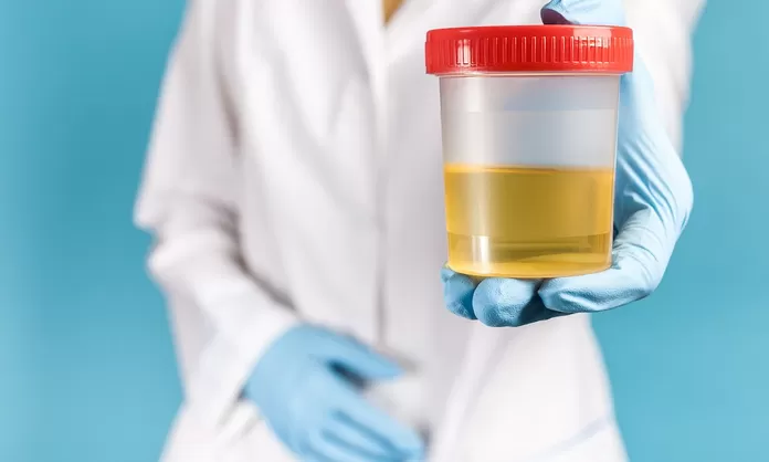 Cuál es el color normal de la orina y significado