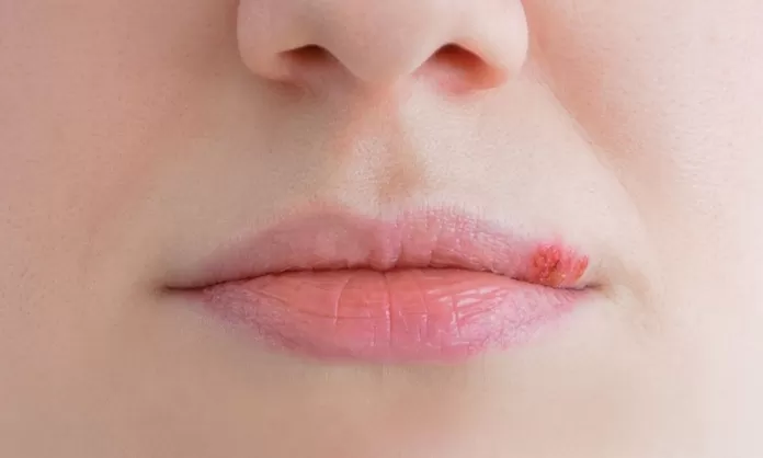 Herpes en el labio: Causas y cómo se cura
