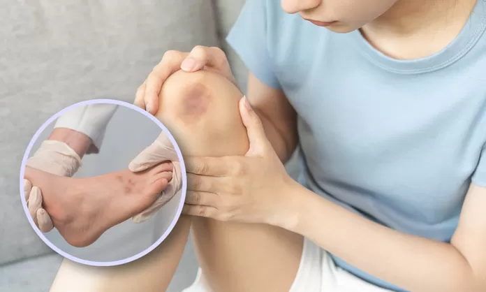 Moretones en niños: ¿En qué casos preocuparse por leucemia?