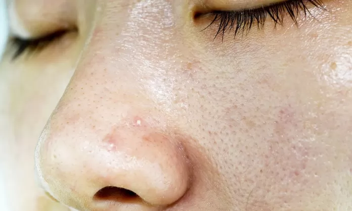 Textura en la piel de la cara