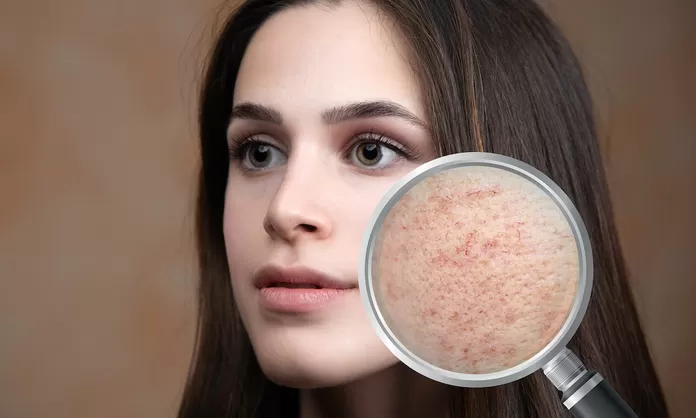 Poros abiertos: Tratamientos más efectivos para mejorar su apariencia