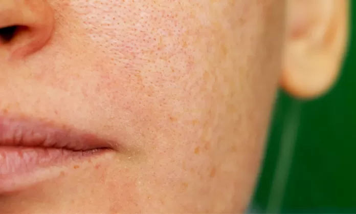 ¿Cómo reducir los poros abiertos en el rostro?