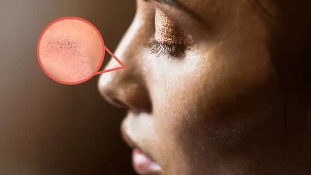 ¿Cómo eliminar los puntos negros sin dañar la piel? - América Noticias