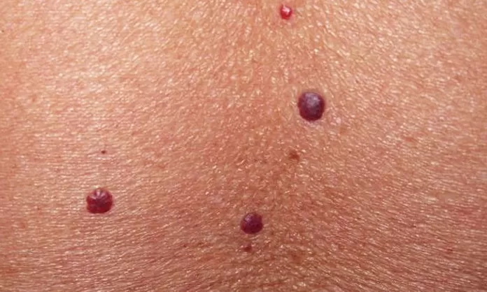 Puntos rojos en el cuerpo: por qué salen y cómo eliminarlos