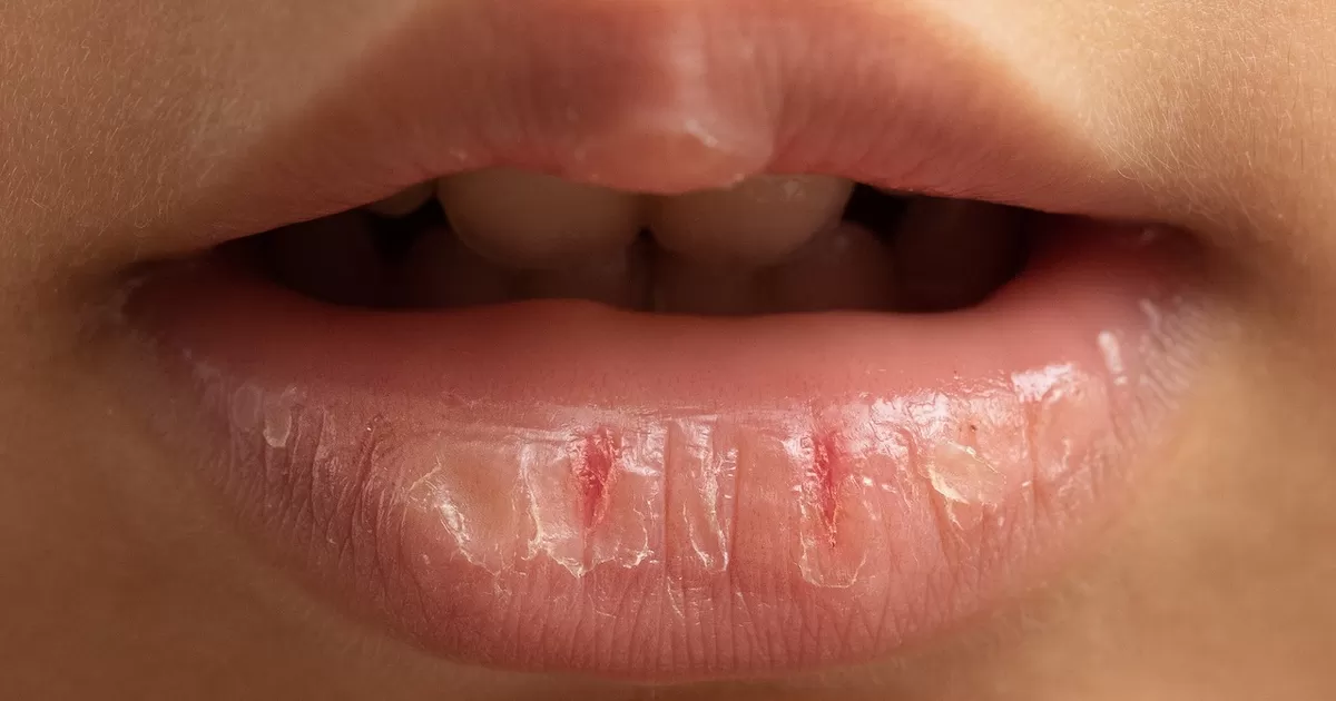 ¿Por qué se resecan los labios y cómo mantenerlos hidratados? - America ...